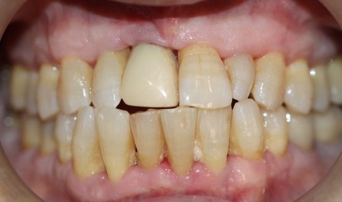 Implantes dentales en Hospitalet de Llobregat, Barcelona